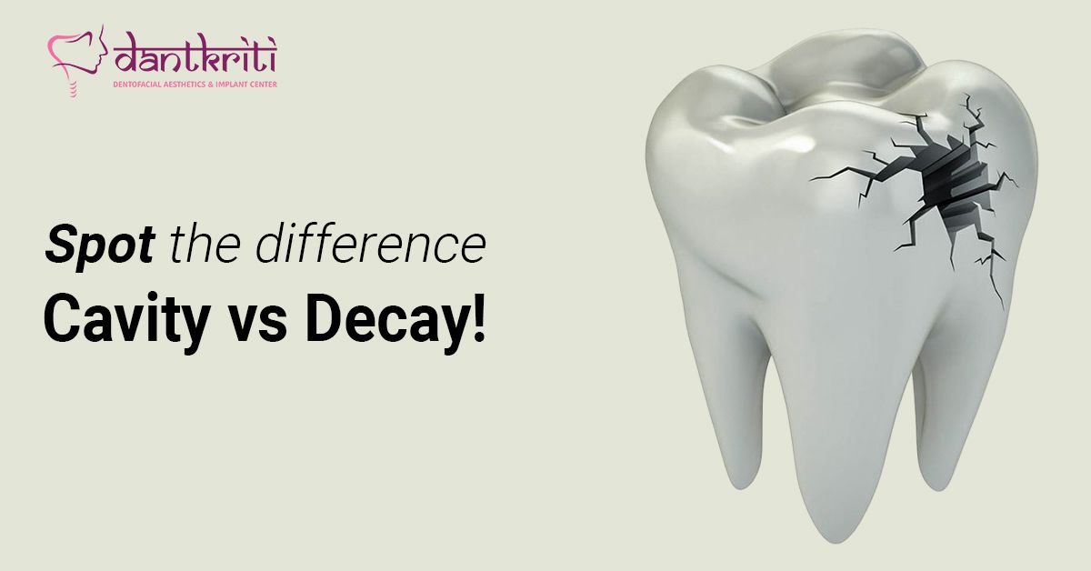 Cavity Vs. Tooth Decay: The Essential Guide To Better Oral Health ...